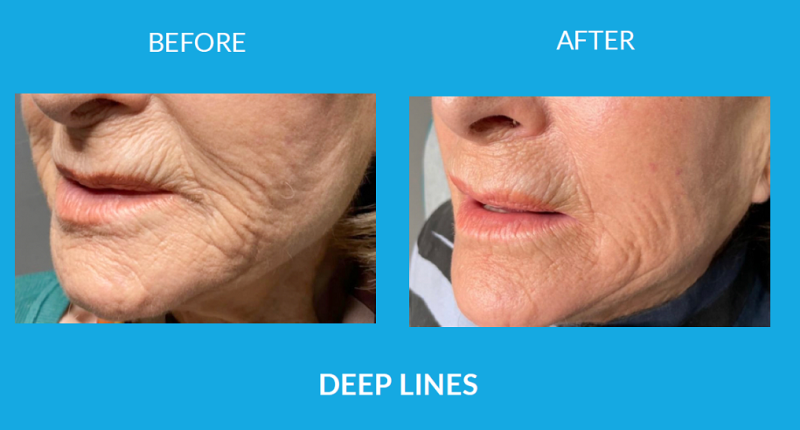 ProCell Therapies Microchanneling - The Body Bar